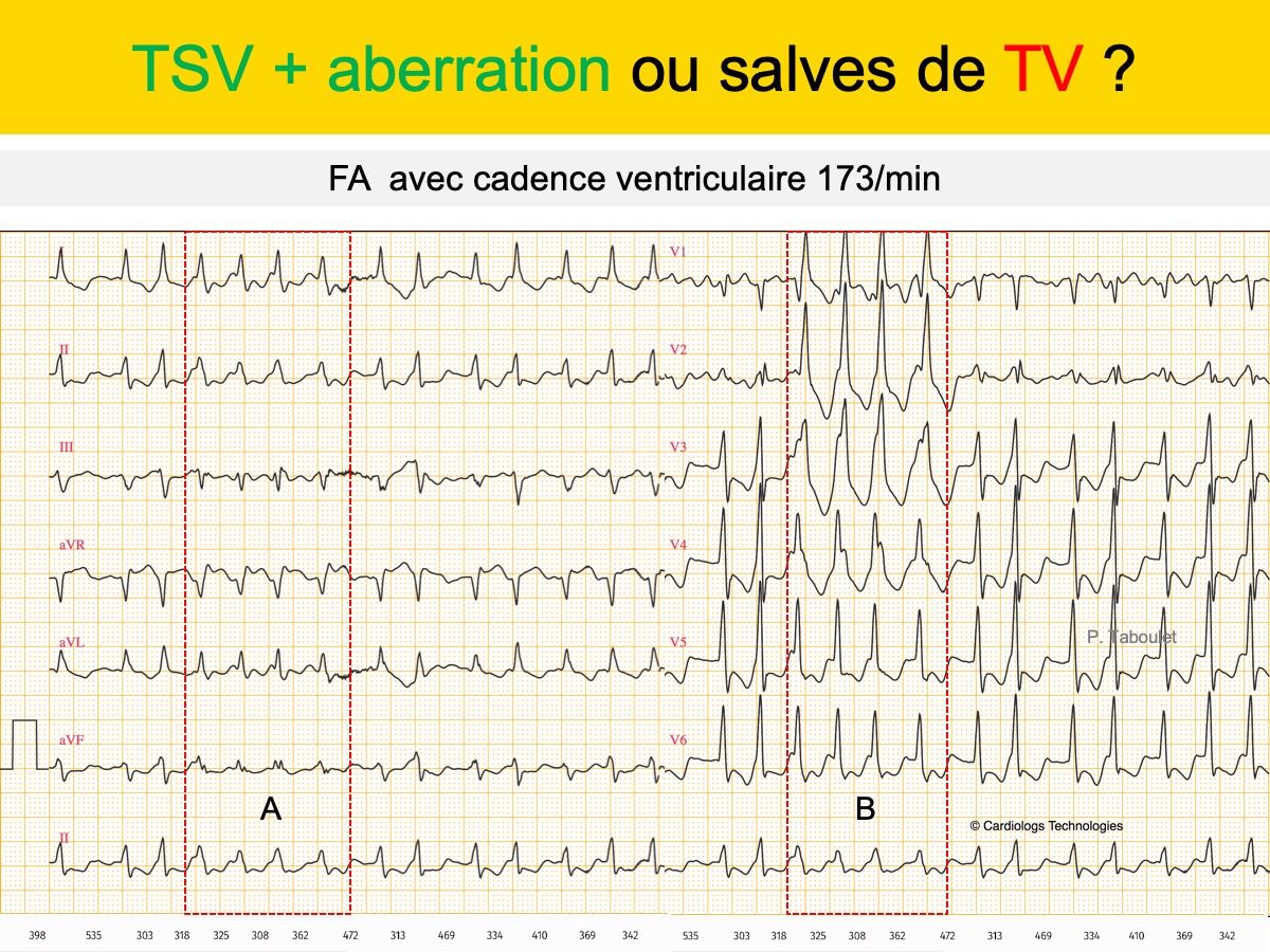 Hypercalcémie : e-cardiogram