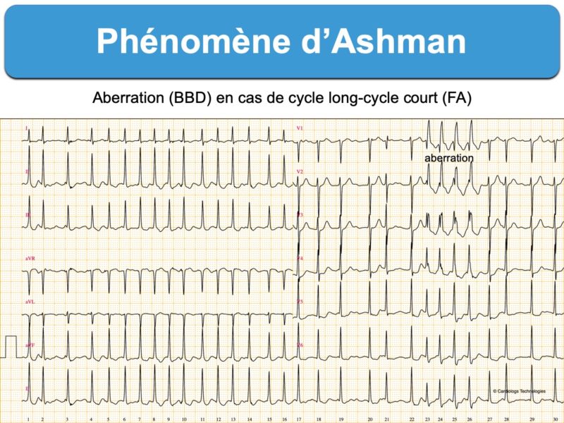 Phénomène d’Ashman : e-cardiogram