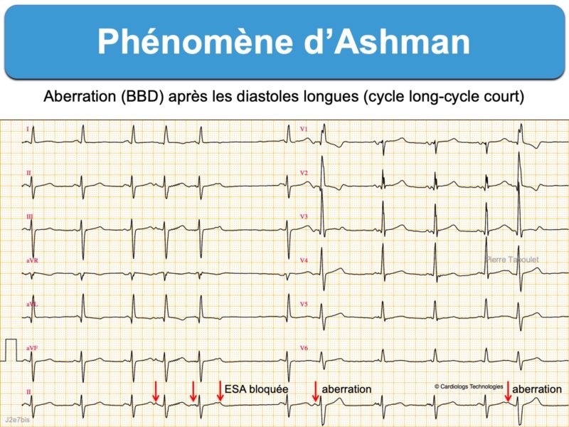 Phénomène d’Ashman : e-cardiogram