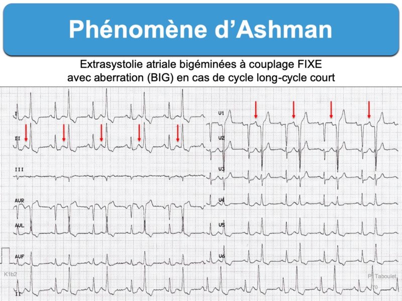 Phénomène d’Ashman : e-cardiogram