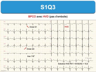 S1Q3 : e-cardiogram