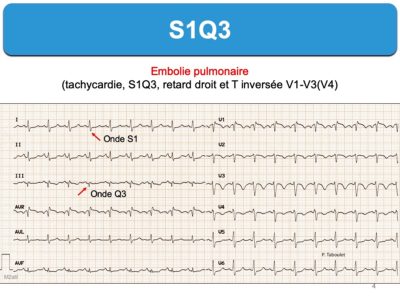 S1Q3 : e-cardiogram