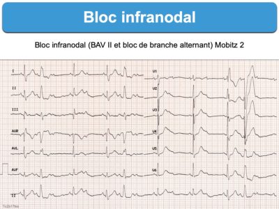 Bloc infranodal : e-cardiogram