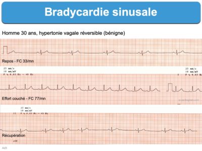 Bradycardie sinusale : e-cardiogram