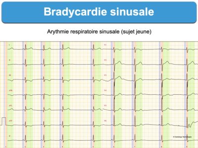 Bradycardie sinusale : e-cardiogram