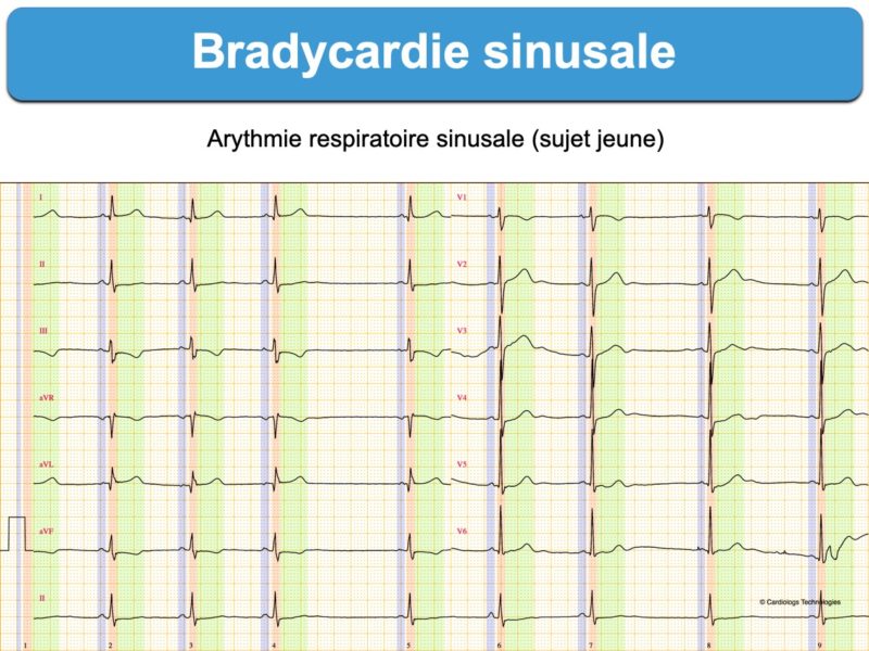 Bradycardie sinusale : e-cardiogram