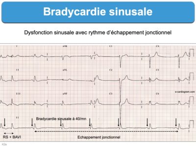 Bradycardie sinusale : e-cardiogram
