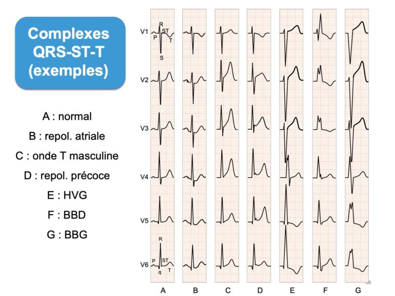 Complexe QRS : e-cardiogram