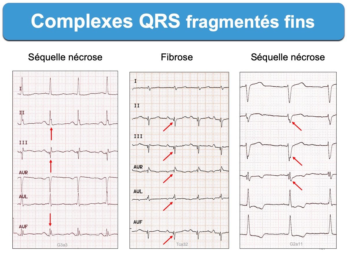 Complexes QRS fragmentés 1. fins : e-cardiogram