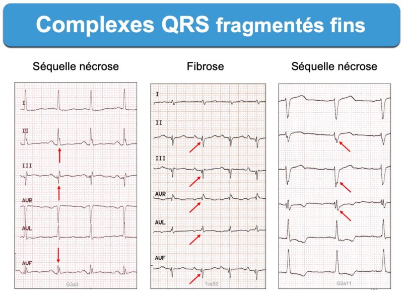 Complexes QRS fragmentés 1. fins : e-cardiogram
