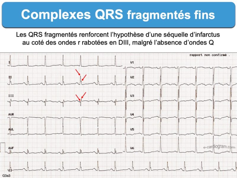 Complexes QRS fragmentés 1. fins : e-cardiogram