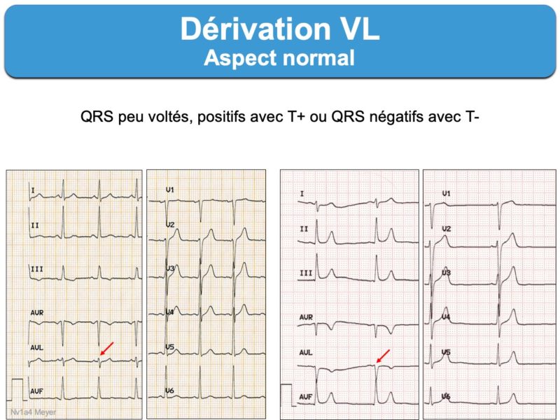 Dérivation VL : e-cardiogram