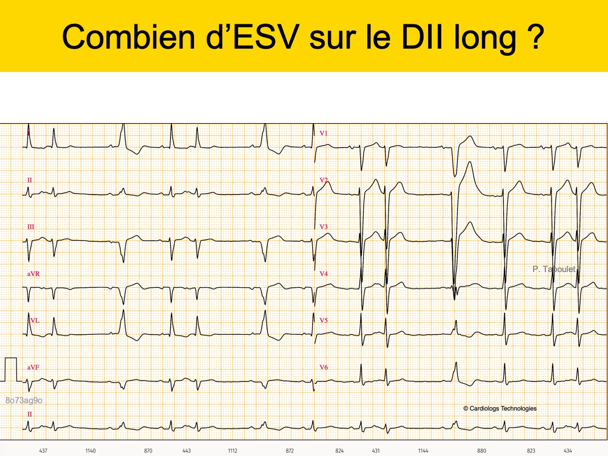 Intervalle QT. 2. QT corrigé (QTc) : e-cardiogram