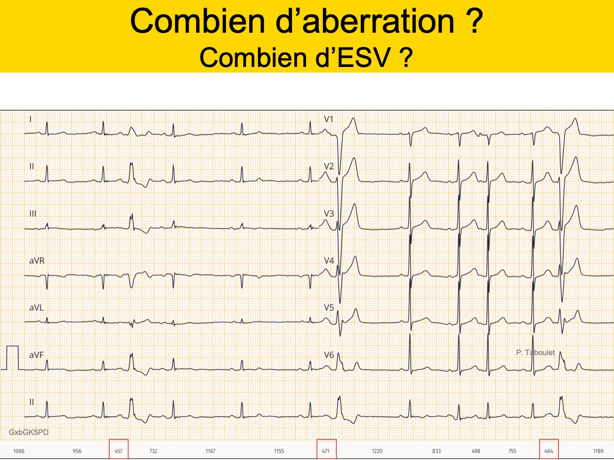 Hypercalcémie : e-cardiogram