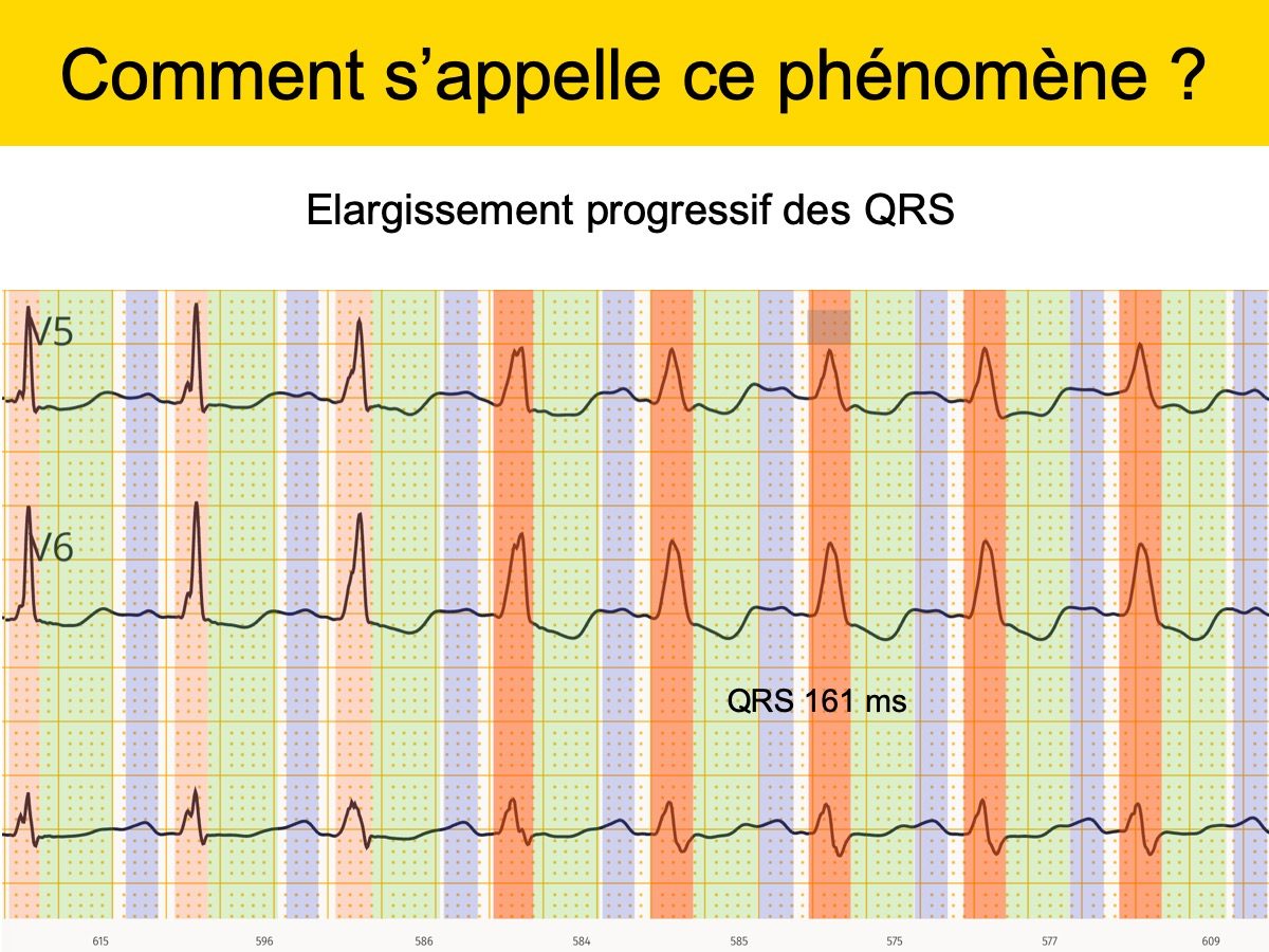 Fibrillation atriale 6. Cardioversion : e-cardiogram
