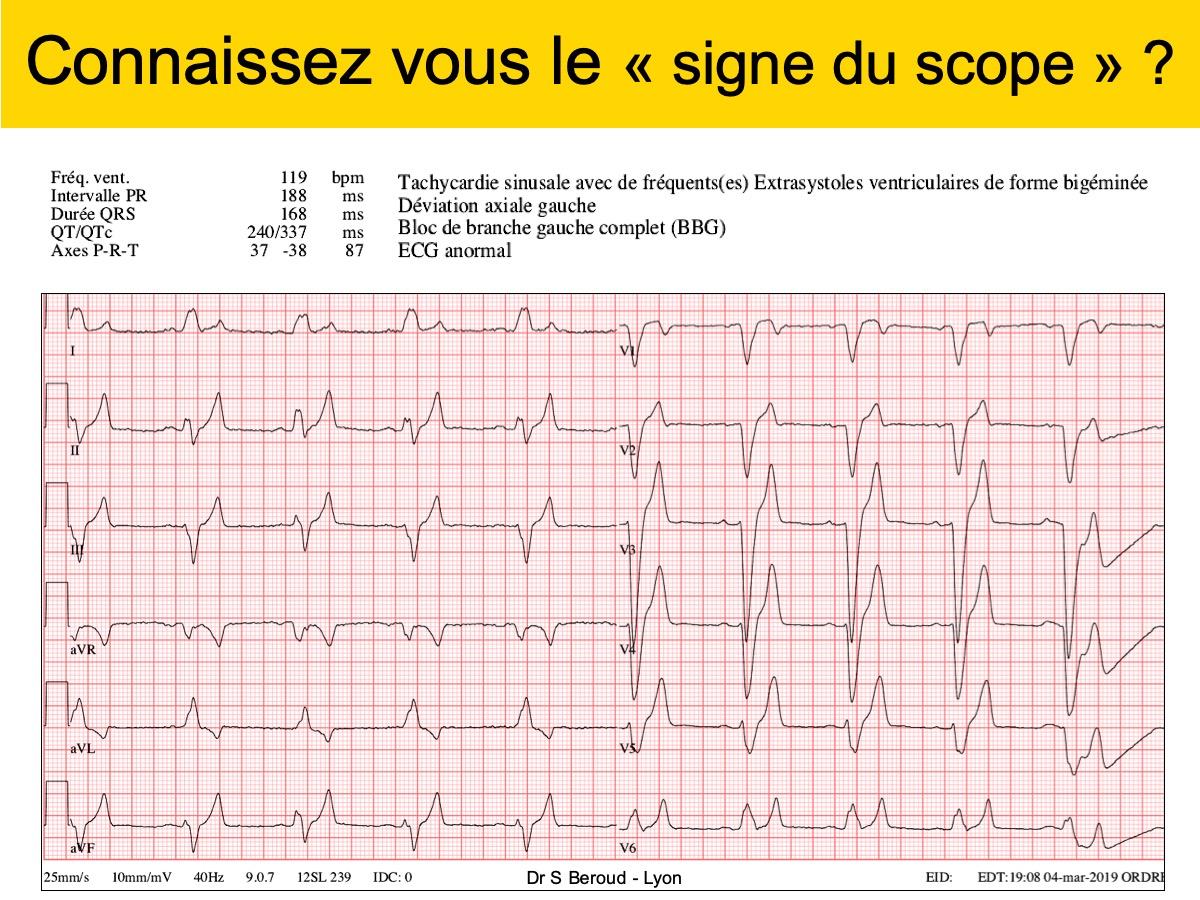 Bloc de branche 2. droit complet : e-cardiogram
