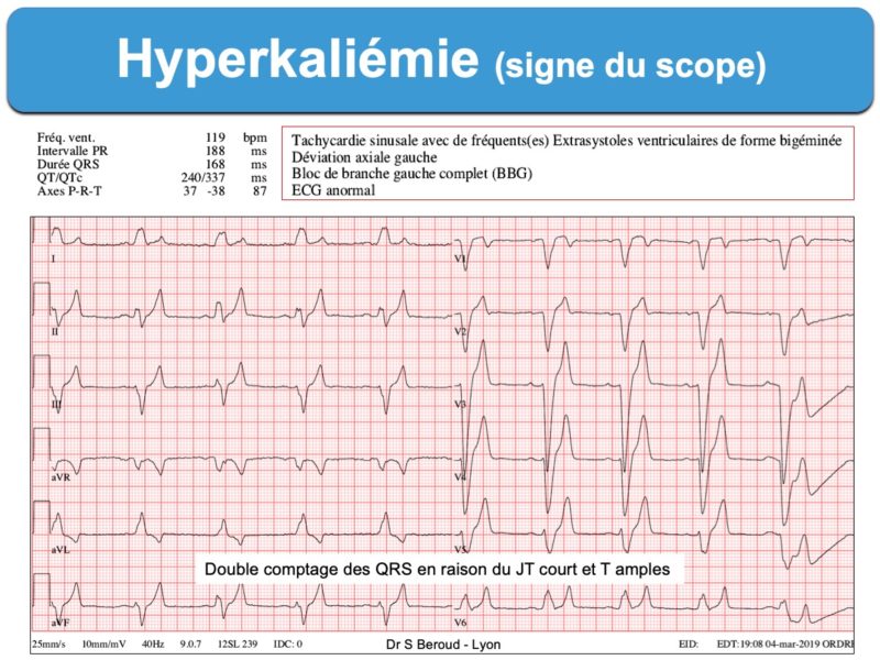 Hyperkaliémie : e-cardiogram
