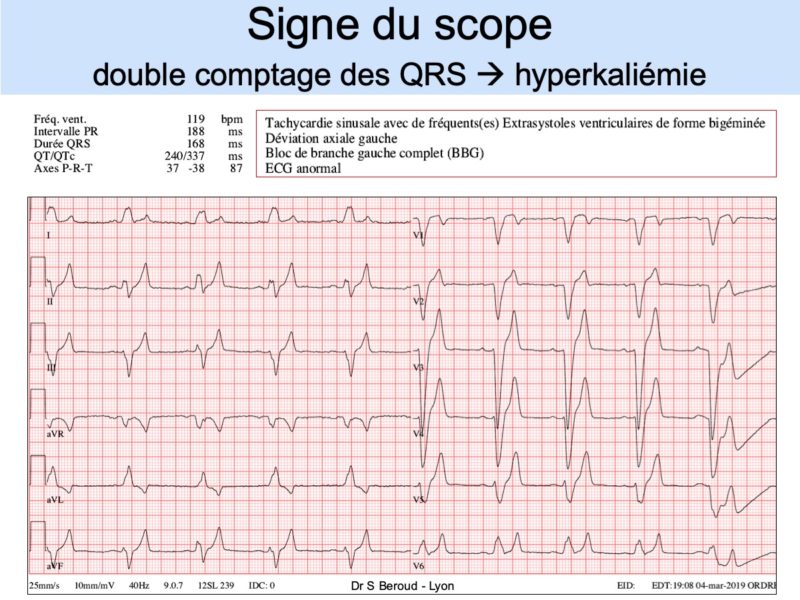 Hyperkaliémie : e-cardiogram