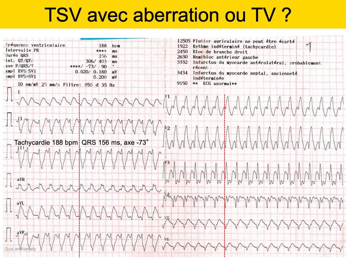 Cœur pulmonaire aigu : e-cardiogram