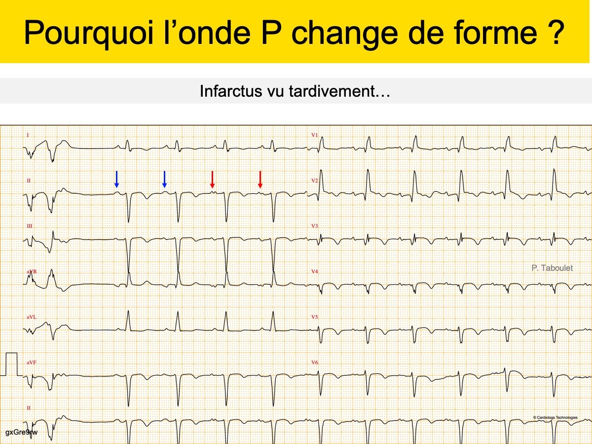 Bloc sino-atrial (BSA) : e-cardiogram