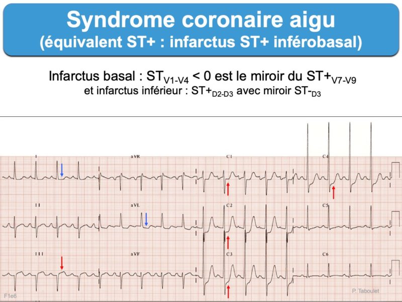 SCA 3b. Non ST+ équivalents ST+ : e-cardiogram