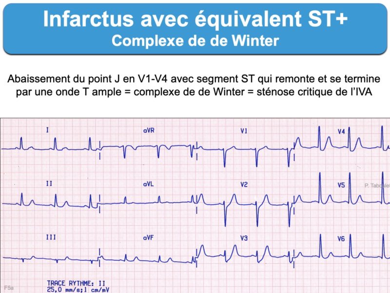 SCA 3b. Non ST+ équivalents ST+ : e-cardiogram