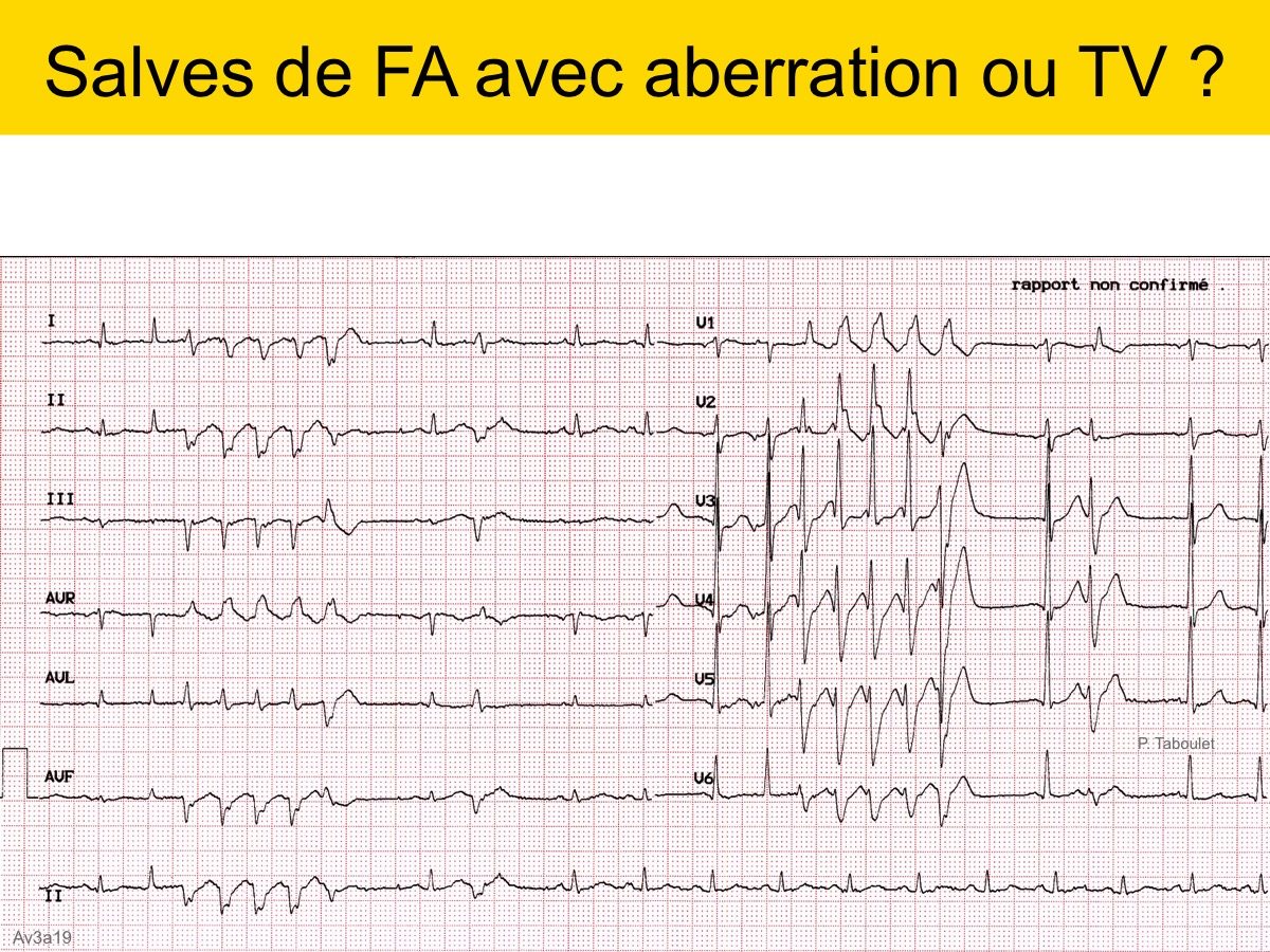 Variabilité sinusale : e-cardiogram