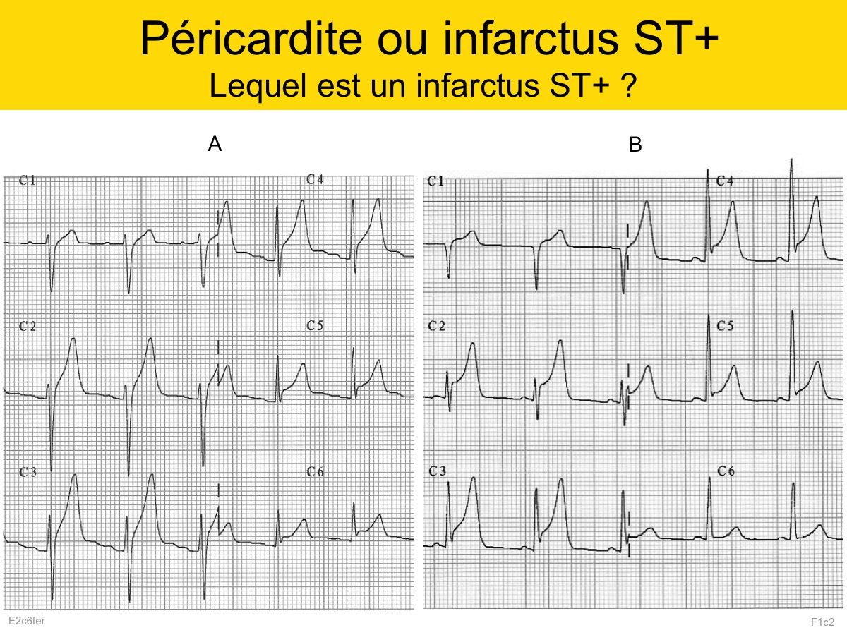 Potentiel seuil : e-cardiogram
