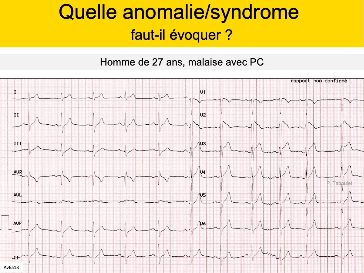 Onde P : e-cardiogram