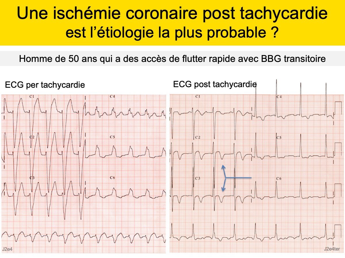 Tachycardies à QRS fins : e-cardiogram