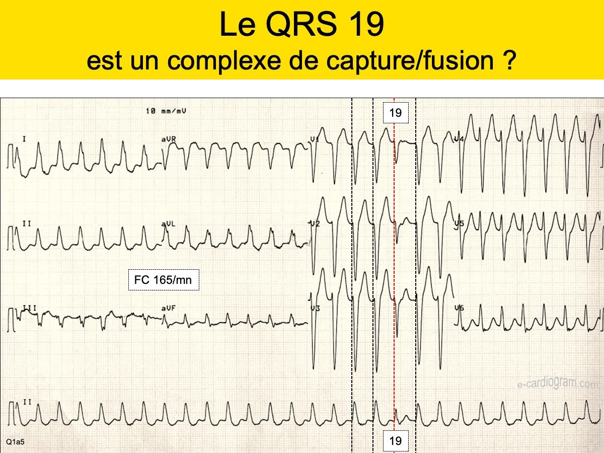 Anomalie d’Ebstein : e-cardiogram