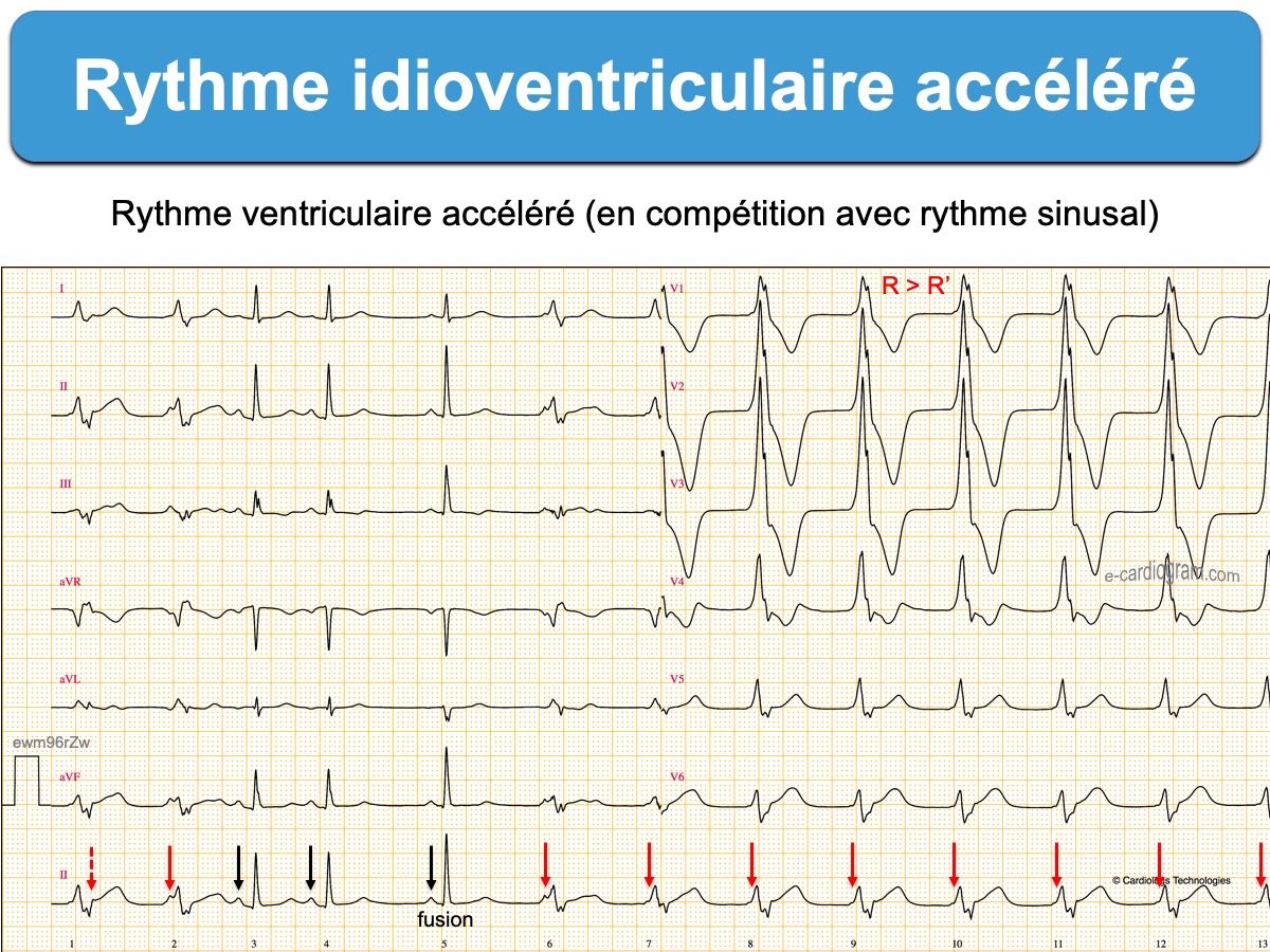 Capture sinusale : e-cardiogram