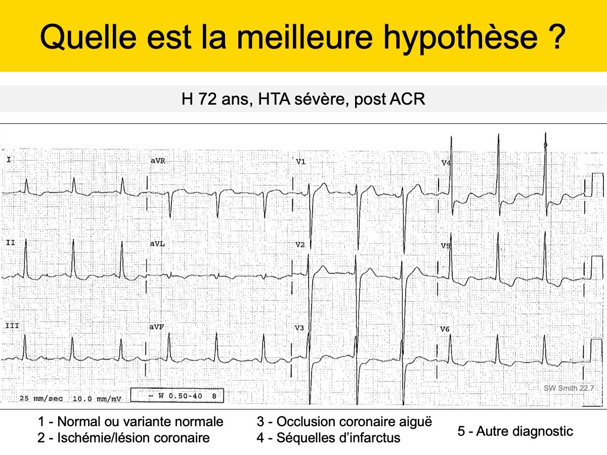 Extrasystole atriale : e-cardiogram