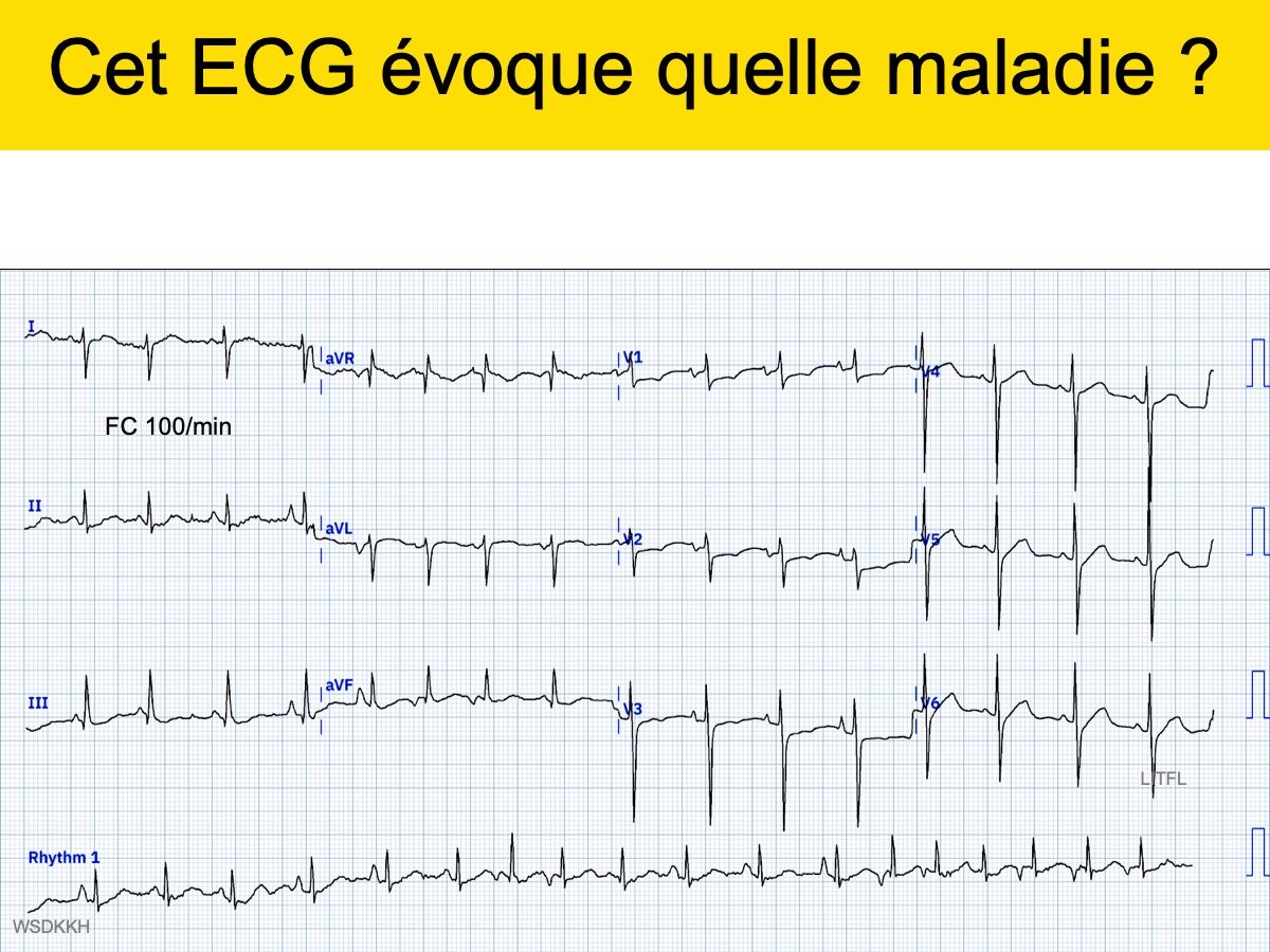 Onde P : e-cardiogram