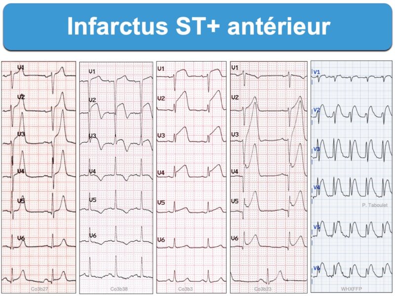 Infarctus 4. Antérieur : e-cardiogram