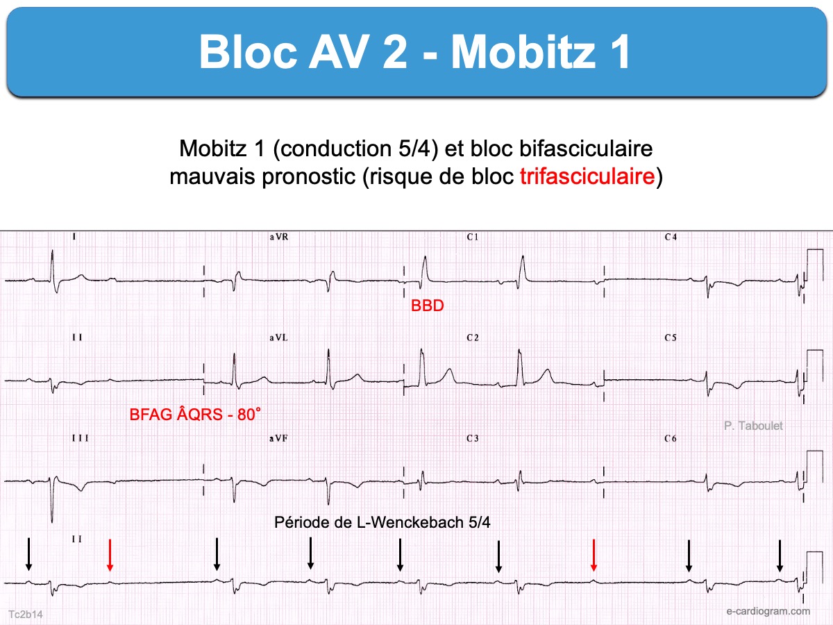 Bloc AV 2e degré. Mobitz 1 : e-cardiogram
