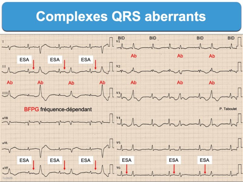 Complexes QRS aberrants : e-cardiogram