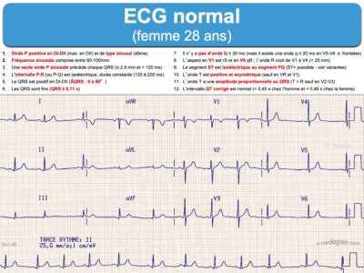 ECG : normal : e-cardiogram