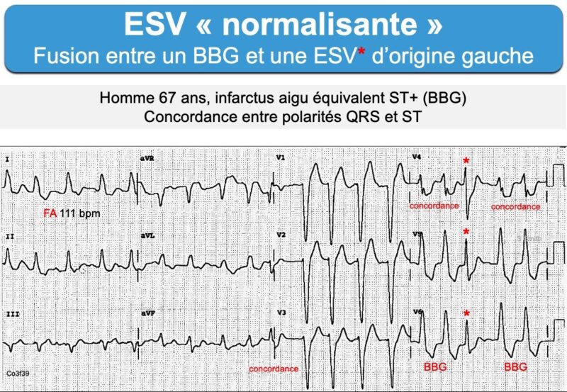 Complexe de fusion : e-cardiogram