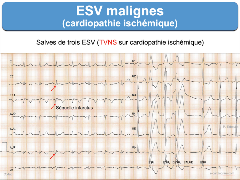 Extrasystoles ventriculaires malignes : e-cardiogram