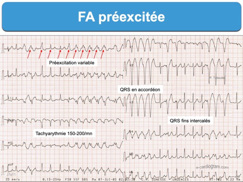 Fibrillation atriale 2. diagnostic ECG : e-cardiogram