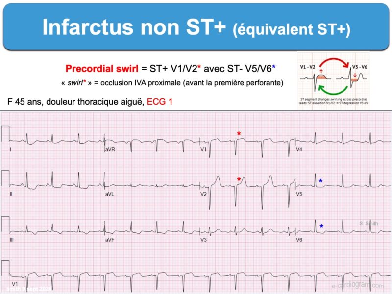 SCA 3b. Non ST+ équivalents ST+ : e-cardiogram