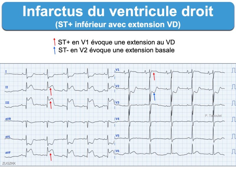 Infarctus 4. Ventricule droit (VD) : e-cardiogram