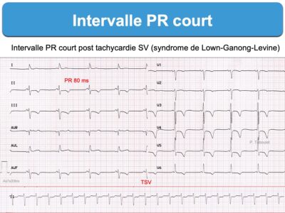 Syndrome de Lown-Ganong-Levine : e-cardiogram