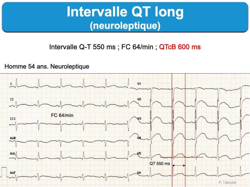 Intervalle QT 3. Long : e-cardiogram