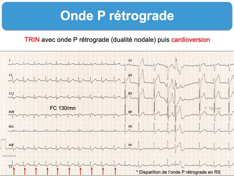 Onde P rétrograde : e-cardiogram