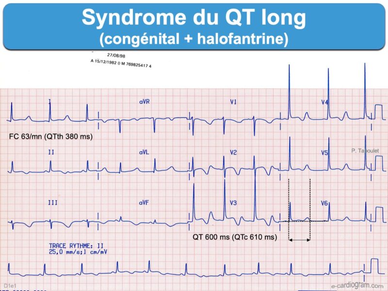 Intervalle QT. 3. Long : e-cardiogram