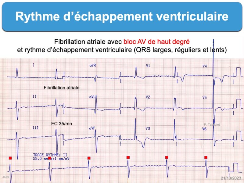 Rythme d'échappement : e-cardiogram