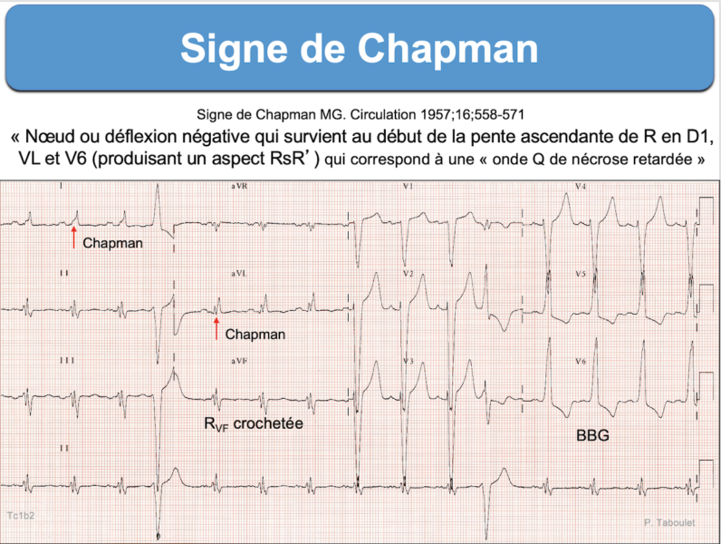 Signe de Chapman : e-cardiogram