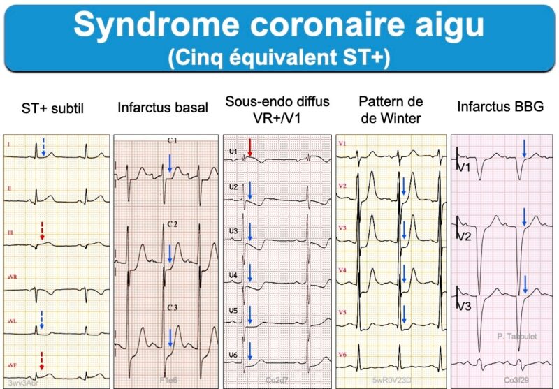 SCA 3b. Non ST+ équivalents ST+ : e-cardiogram